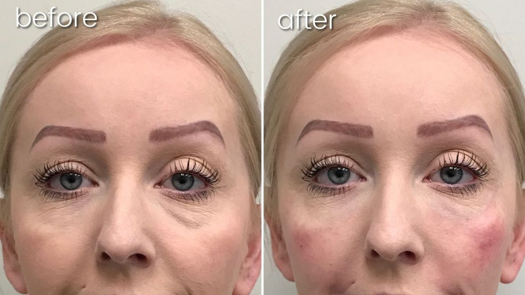 Facial Fillers Bakersfield, CA | Synergy Wellness Center