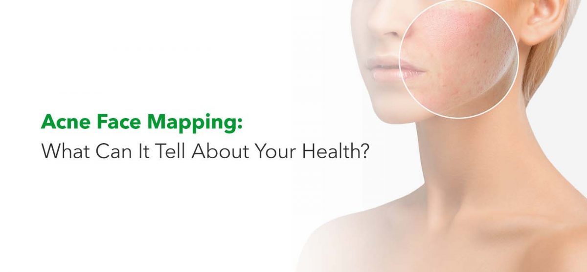 Acne Face Mapping: What Can It Tell About Your Health? - Synergy Wellness