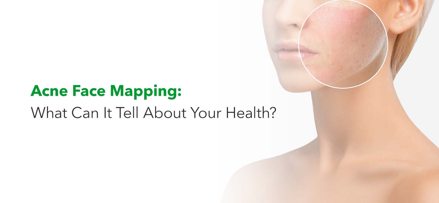 Acne Face Mapping: What Can It Tell About Your Health? - Synergy Wellness