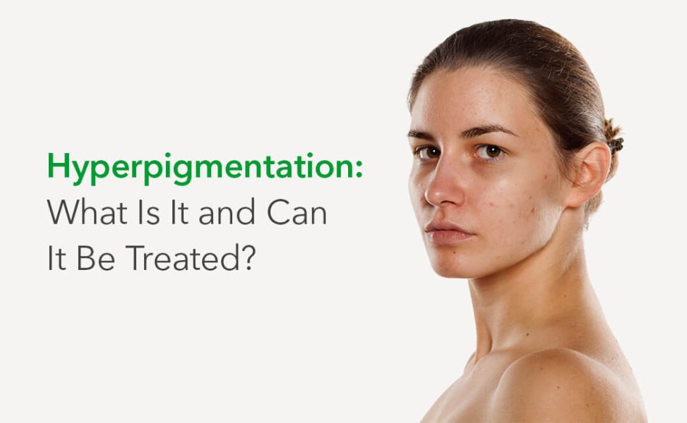 Hyperpigmentation: What Is It and Can It Be Treated? - Synergy Wellness