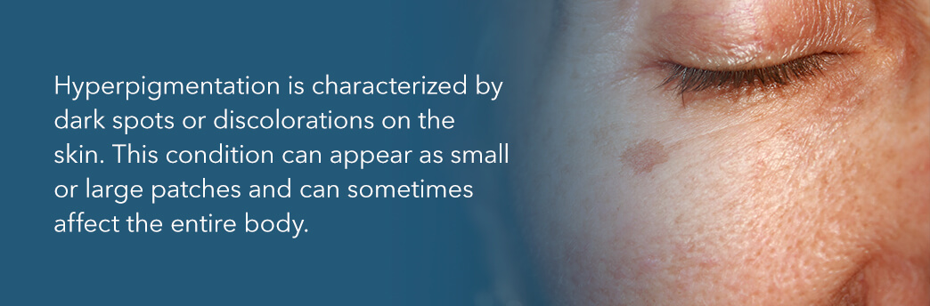 Hyperpigmentation: What Is It and Can It Be Treated? - Synergy Wellness