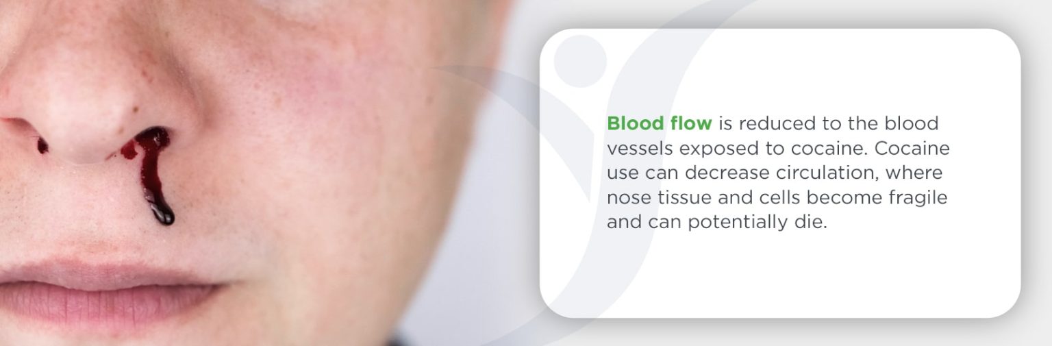 Snorting Drugs and Signs of Nose Damage - Synergy Wellness